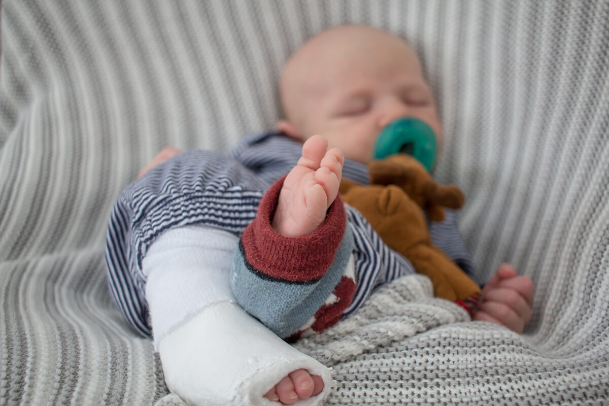 3 Non-Surgical Treatments for Talipes - Cii Central